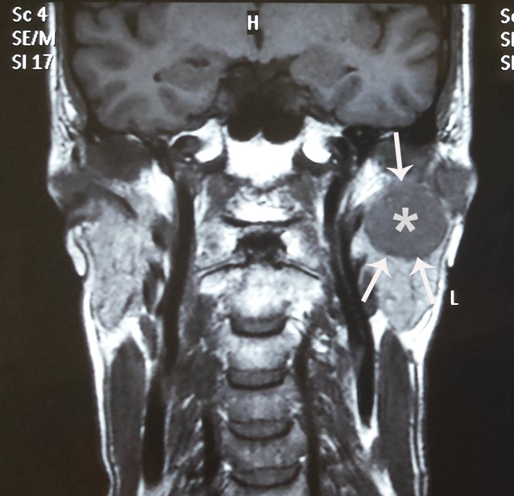 Parotid Tumours - Dr Dharambir S Sethi