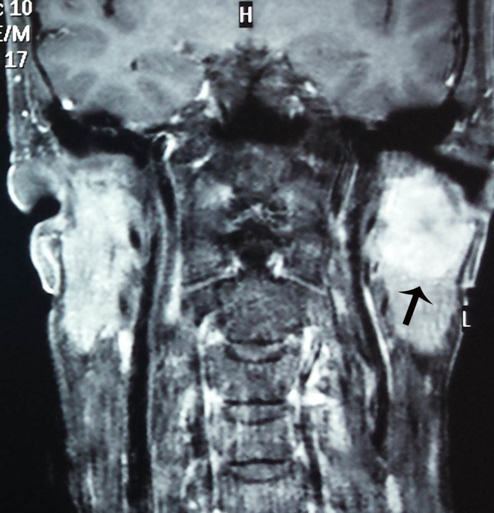 Parotid Tumours - Dr Dharambir S Sethi